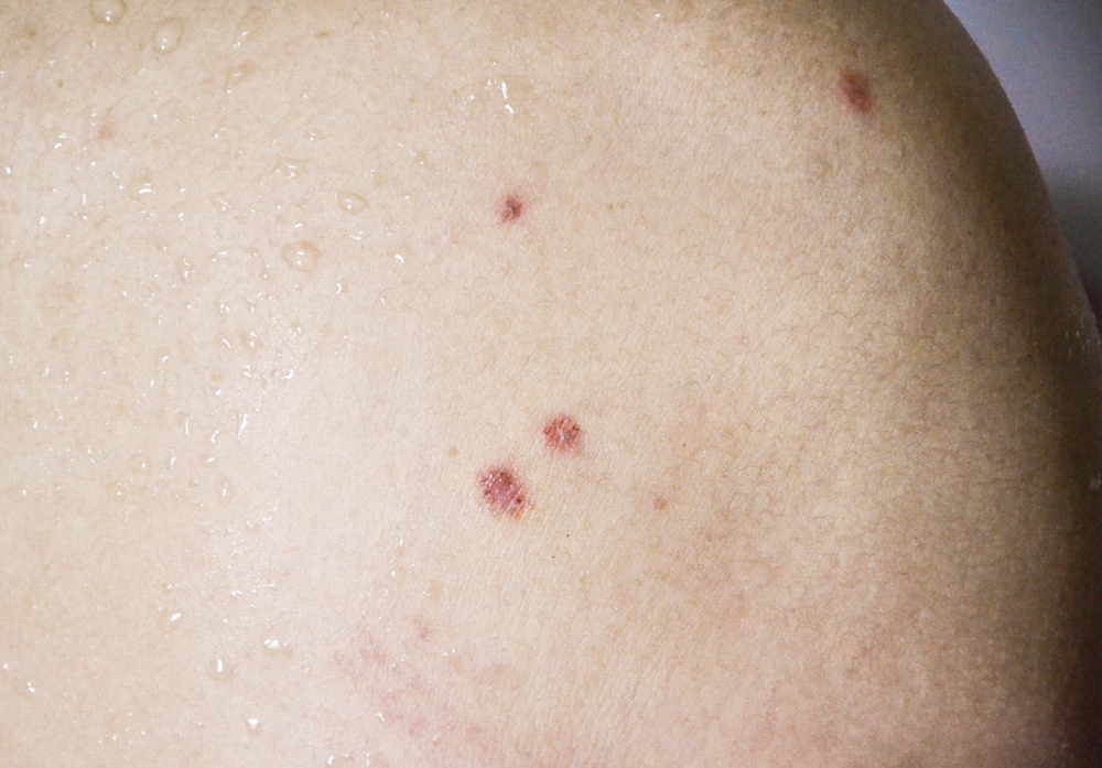 Morbus Bowen - Lootskliniek