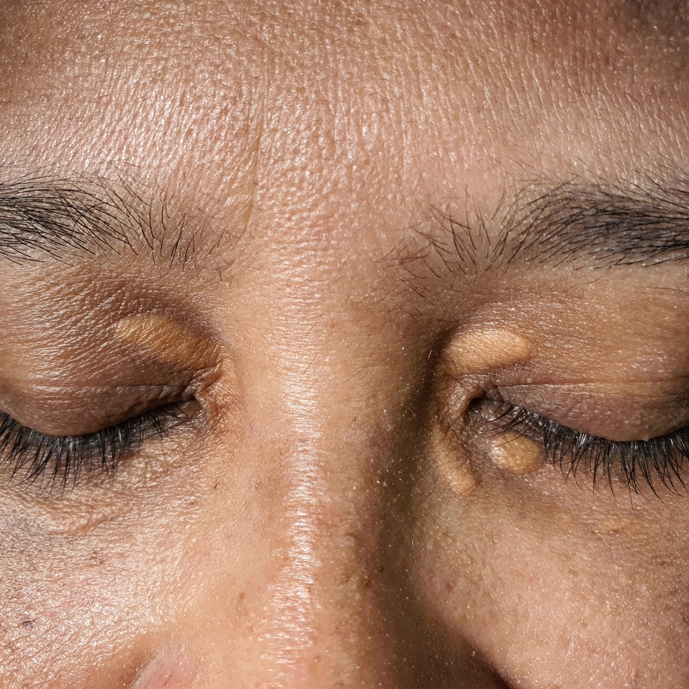 Xanthelasma palpebrare - Lootskliniek